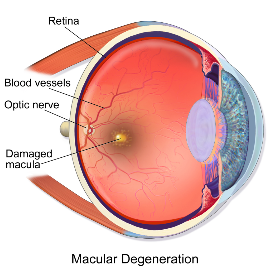 Macular Degeneration | Retina Specialists